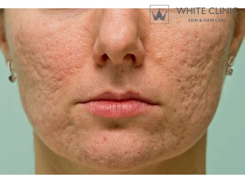 Phương Pháp Trị Sẹo Rỗ Hiệu Quả: Công Nghệ Tiên Tiến Nào Mang Lại Làn ...